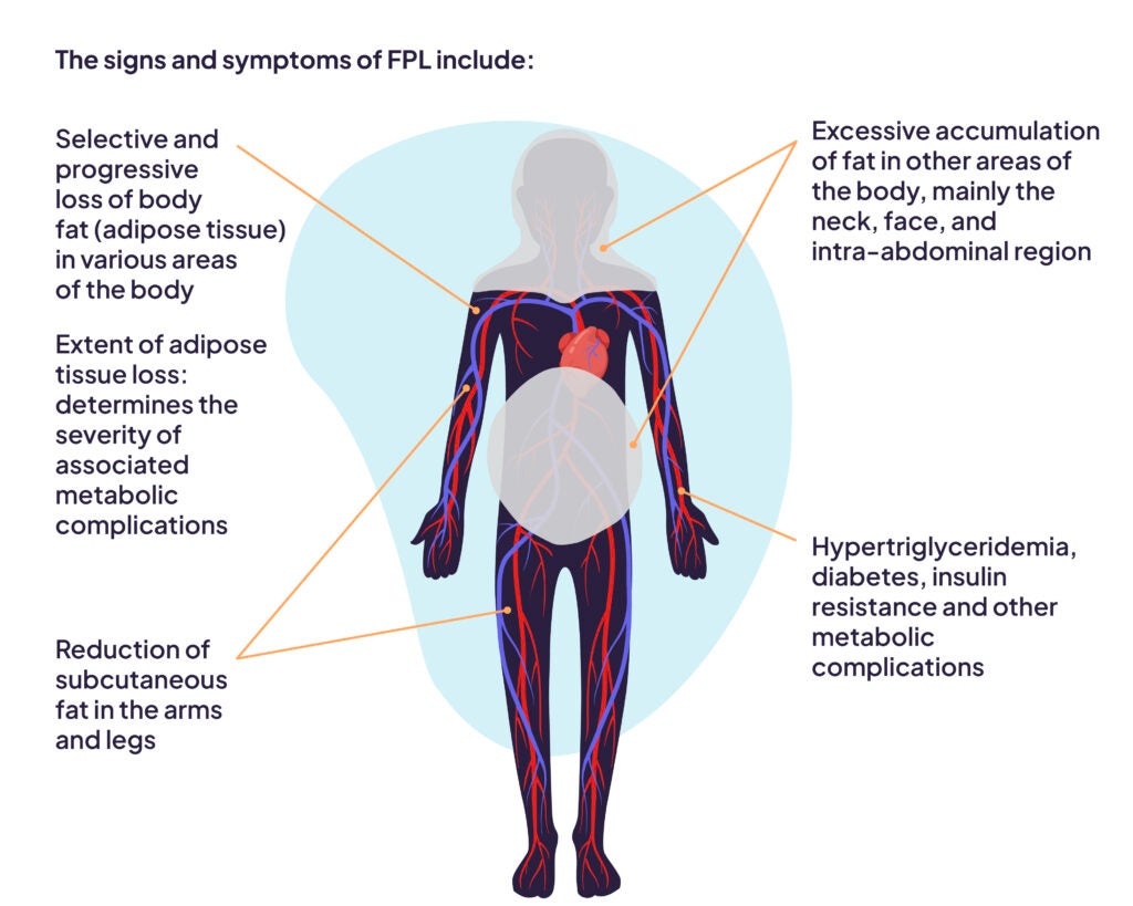 Familial partial lipodystrophy - PTC Therapeutics (United States)